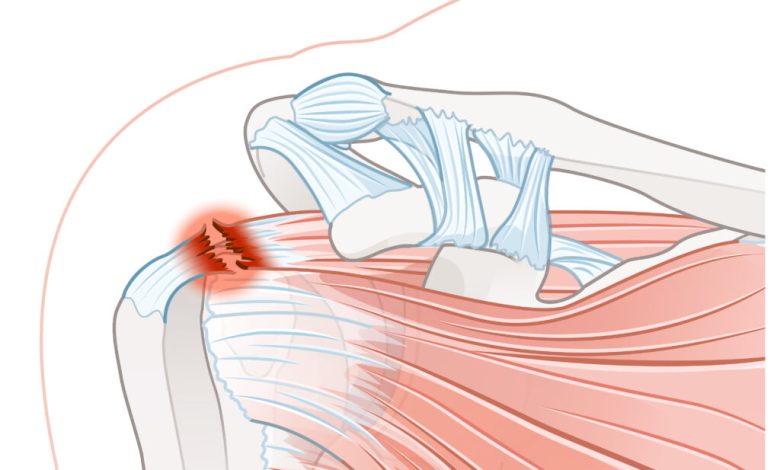 پارگی روتاتور کاف شانه چیست؟ | علائم پارگی روتاتور کاف شانه | دکتر کامرانی